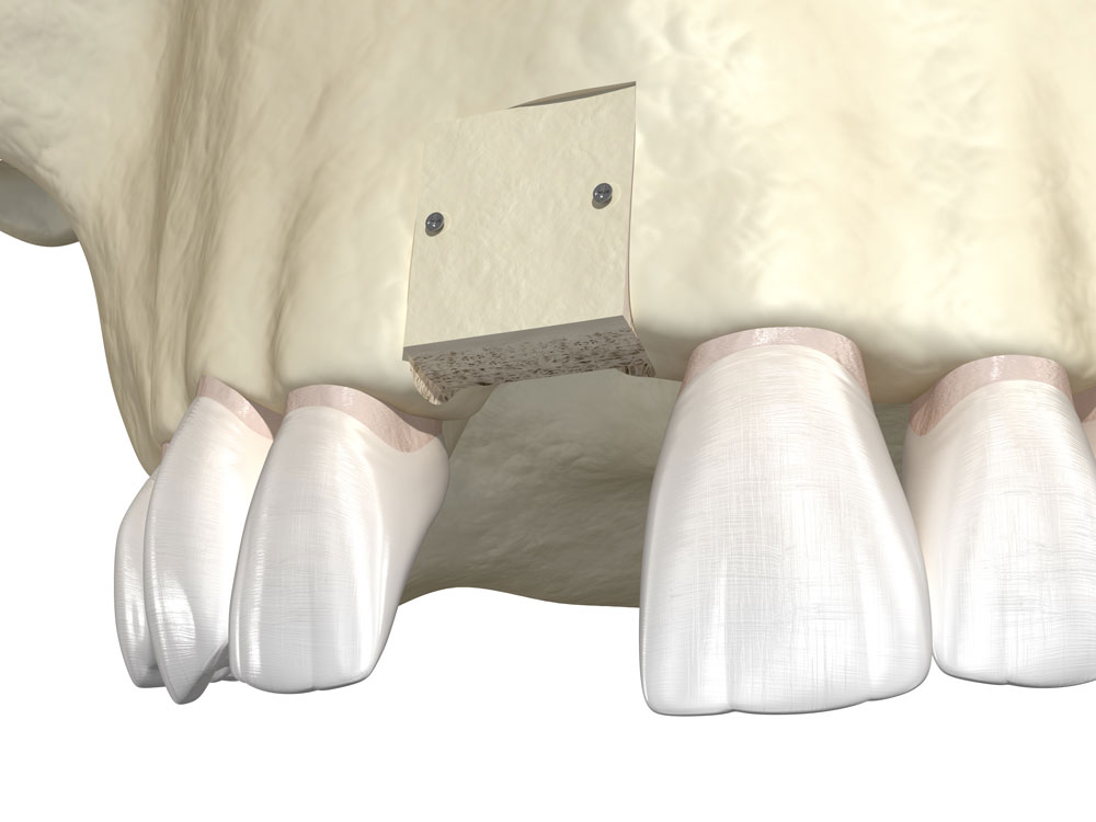 Bone Grafting Sarasota FL | After Tooth Extraction
